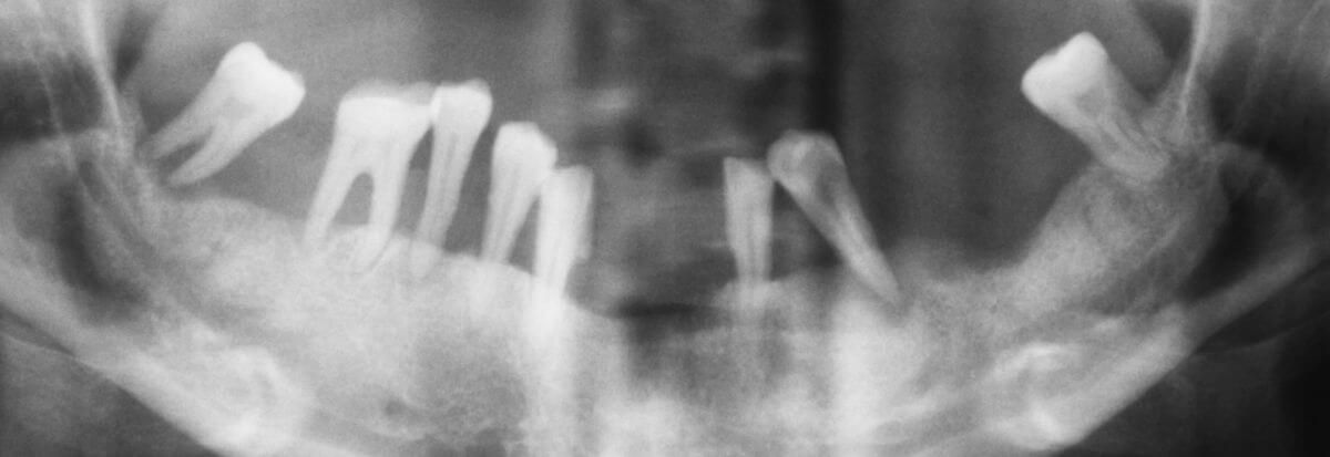 Bone recession - the solution is here! | 5 day implant system